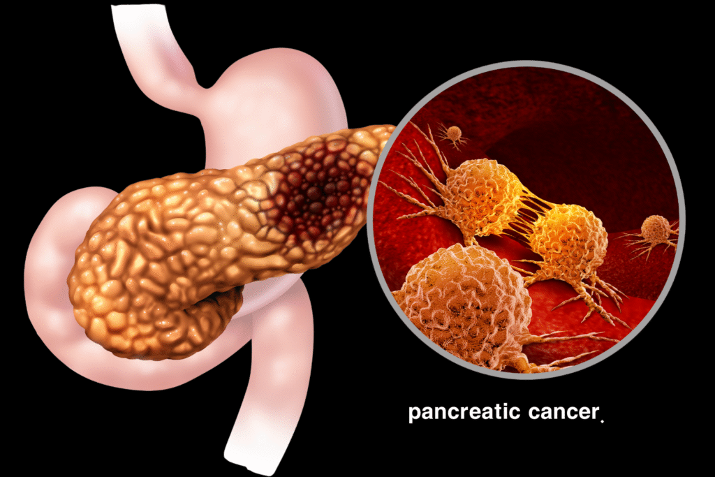 Middlesex County Plans Annual Pancreatic Cancer Walk at Roosevelt Park ...